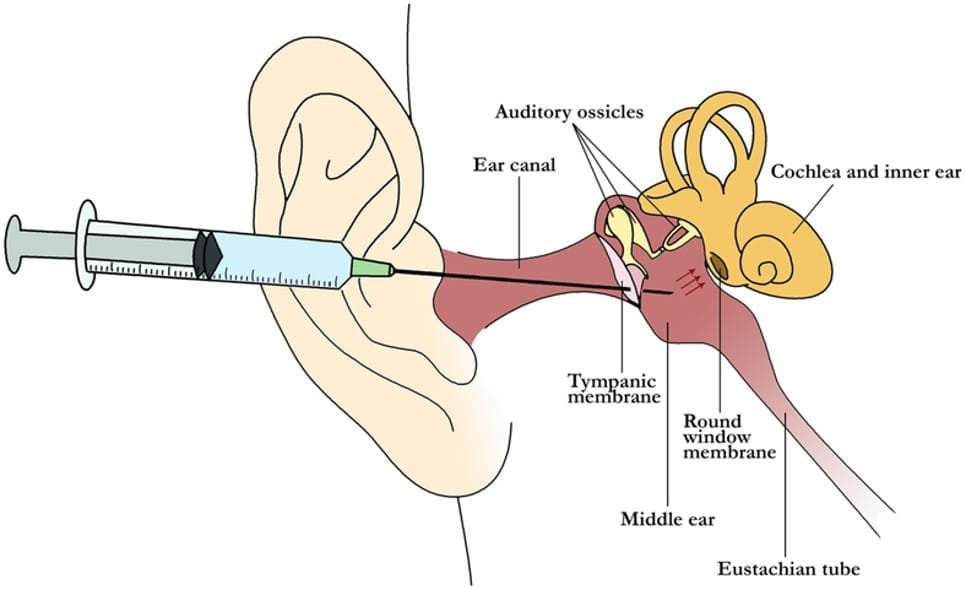 Intratympanic Gentamicin and Cortisone Injections | Akdeniz Vertigo Merkezi